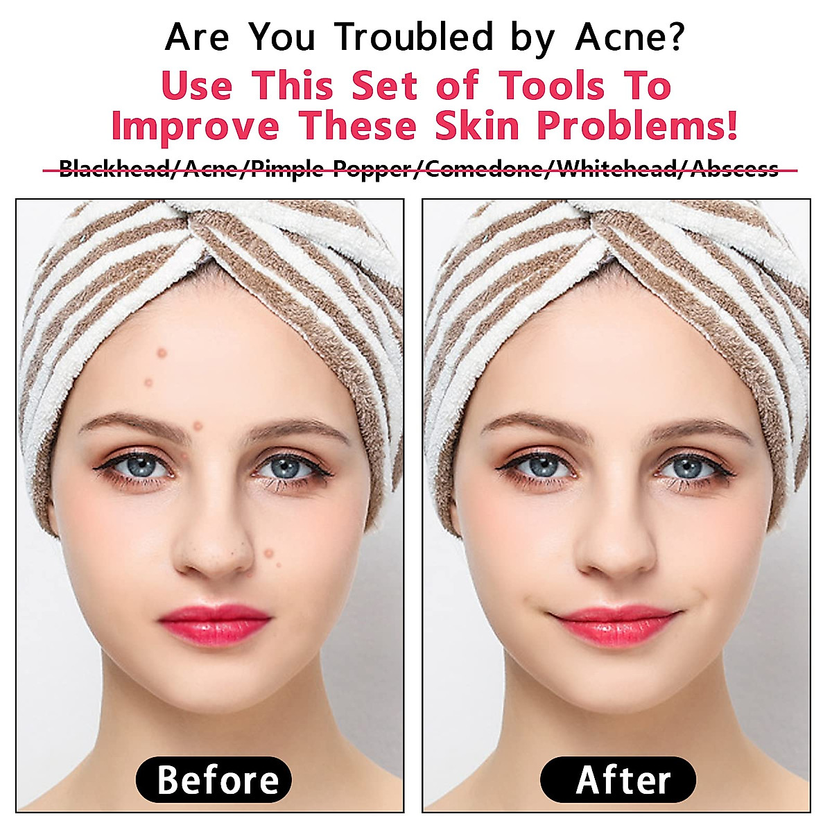 Xesscare Pimple Popper Tool Kit 7 Pcs Blackhead Remover Tool Comedones Tweezers Acne Extractor Blemish Whitehead Removal Tool for Facial, Nose and Forehead (Silver)