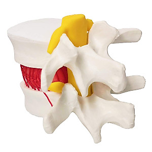 Human Herniated Disc Model, Anatomical Herniated Lumbar Vertebrae Disc Prolapse Model for Medical Teaching Learning, Kids Learning Education Display Toolning, Kids Learning Education Display Tool