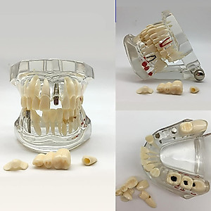 Smedent Dental Study Teaching Teeth Model Adult Typodont Model Removable Tooth