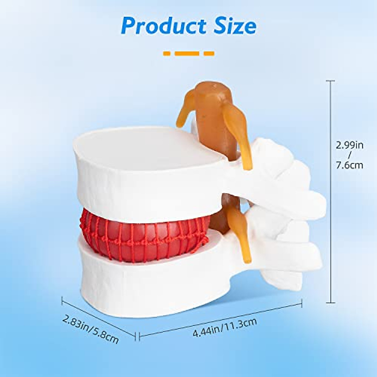 faruijie Disc Herniation Model - 1.5X Lumbar Herniated Disc Model Vertebral Spine Anatomical Medical Model