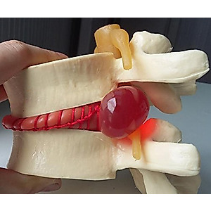 New 2pcs Anatomical Human Lumbar Vertebrae Degenerative Lumbar disc herniation demonstration model Human spine Sold by East Dental