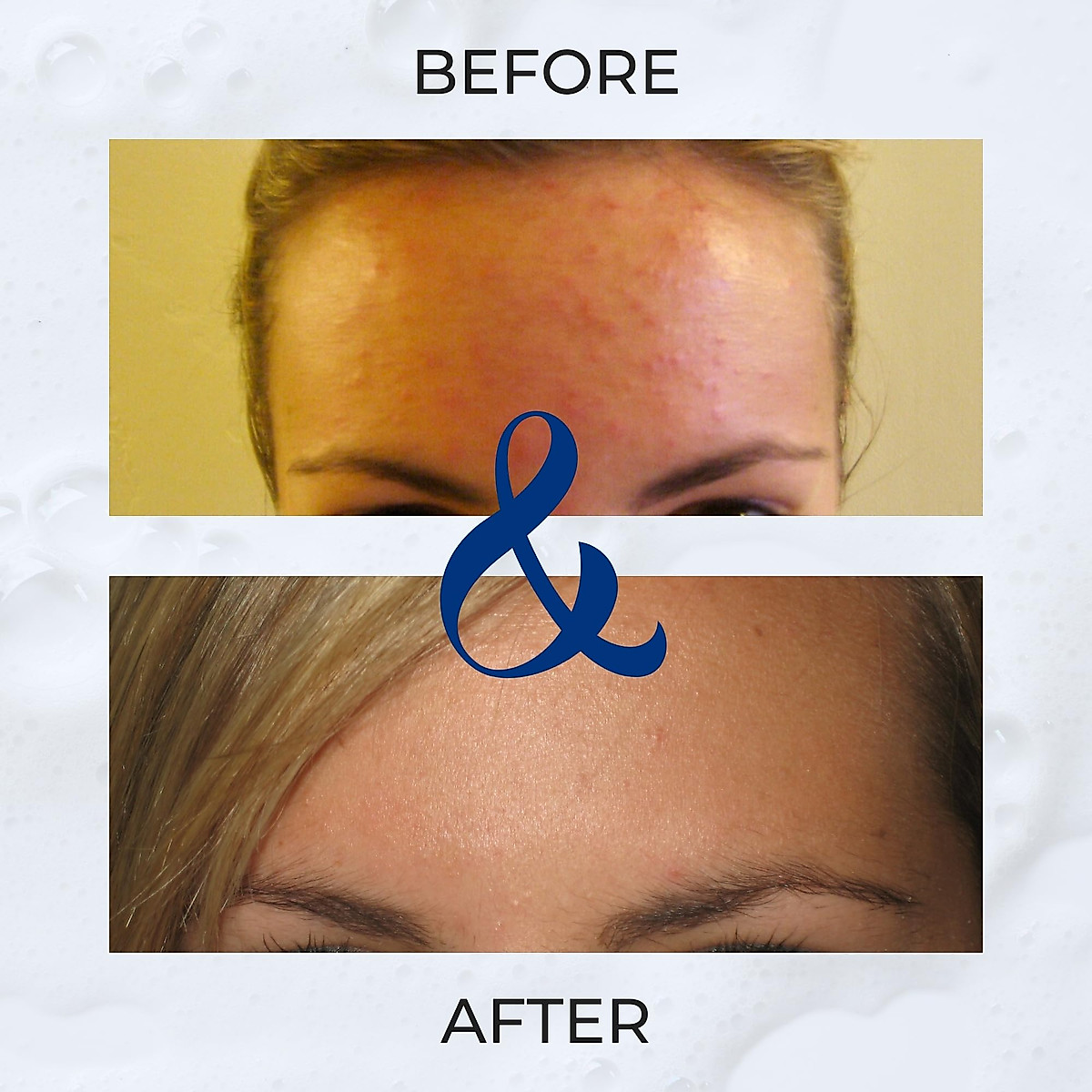 Exfoliating Facial and Body Scrub by Clear 2 Perfection, Esthetician Developed, Perfect for Bacne, Exfoliates & Clears Breakouts