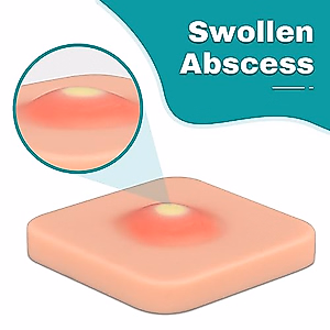 Ultrassist Abscess I&D Incision and Drainage Pad (6-Pack), Sebaceous Cyst Removal Trainer, Suture Practice Skin Pad for Medical Education