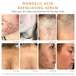 Almond Clear Level 1 Serum | Mandelic Acid Facial Serum for Acne, Folliculitis, Aging Skin, Ingrown Hairs, Dark Spots on Face, Chest, Butt, Back, Thighs, Arms | 1oz