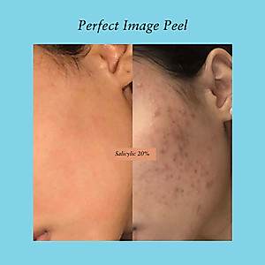 Salicylic Gel Chemical Peel - Enhanced with Green Tea Extract and Tea Tree Oil (20% Strength)