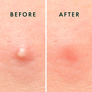 Rael Pimple Patches, Miracle Invisible Spot Cover - Hydrocolloid Acne Patch, Treatment for Breakouts, Absorbs Zits & Blemish, Korean Skin Care, 2 Sizes (48 Count)