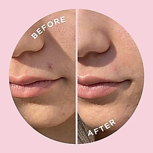 ZitSticka Beyond The Surface Bundle: Killa Microdart Acne Pimple Patches & Goo Getter Hydrocolloid Patch Bundle