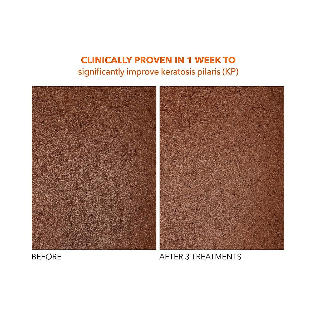 Dr Dennis Gross Alpha Beta Exfoliating Body Treatment | Multi-Tasking Powered by AHA/BHAs for Smooth, Hydrated Skin While Improving Ingrown Hairs, Keratosis Pilaris, and Blemishes | 8 Textured Towels