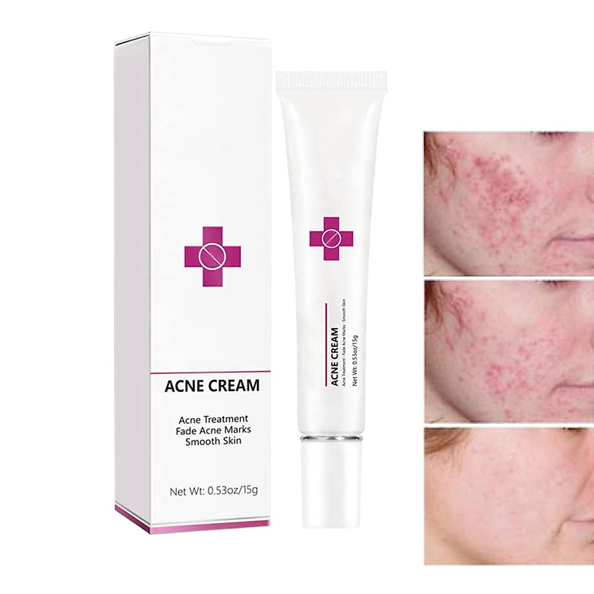 Acne Cream Pimple Cream for Face, Oil Control Pimple Remover Cream Get Rid of Pimples Fast,for Oily and Acne Prone Skin, Cruelty Free, Crema para espinillas en la cara