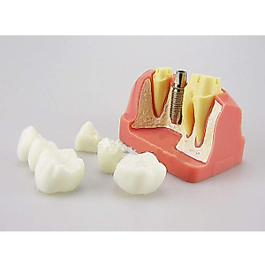 Analysis Model for Dental Implant Crown Bridge Demonstration Teeth Model for Education M2017