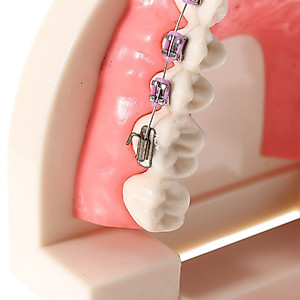 Angzhili 1 Piece Dental Demonstration Orthodontic Model with Metal Wires and Bracket (Metal bracket)
