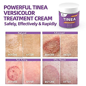 DR. DERM Tinea Versicolor Treatment, Antifungal Cream for Tinea Versicolor & Pedis, All-Natural Athletes Foot Treatment Ringworm Treatment for Humans, Fast Healing Anti Fungal Skin Cream