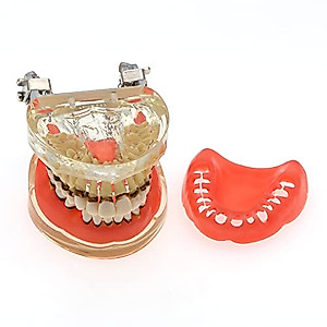 Dental Teeth Typodonts Model for Parodontopathy Periodontal Disease, Removable Gingivae Pathology Teeth Model Used in Teaching,Explain,Studying for Adult(Transparent)