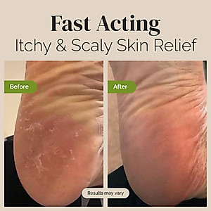 Tea Tree Oil Balm, Extra Strength, Pair Well with Jock Itch Cream, Spray, Athletes Foot, Ringworm Cream for Human, Rash Cream, Fast Acting for Dry, Itchy Skin, Plant Powered Wonder Balm