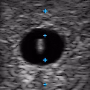 0705 - Vascular Access Ultrasound Phantom, Lightly pigmented