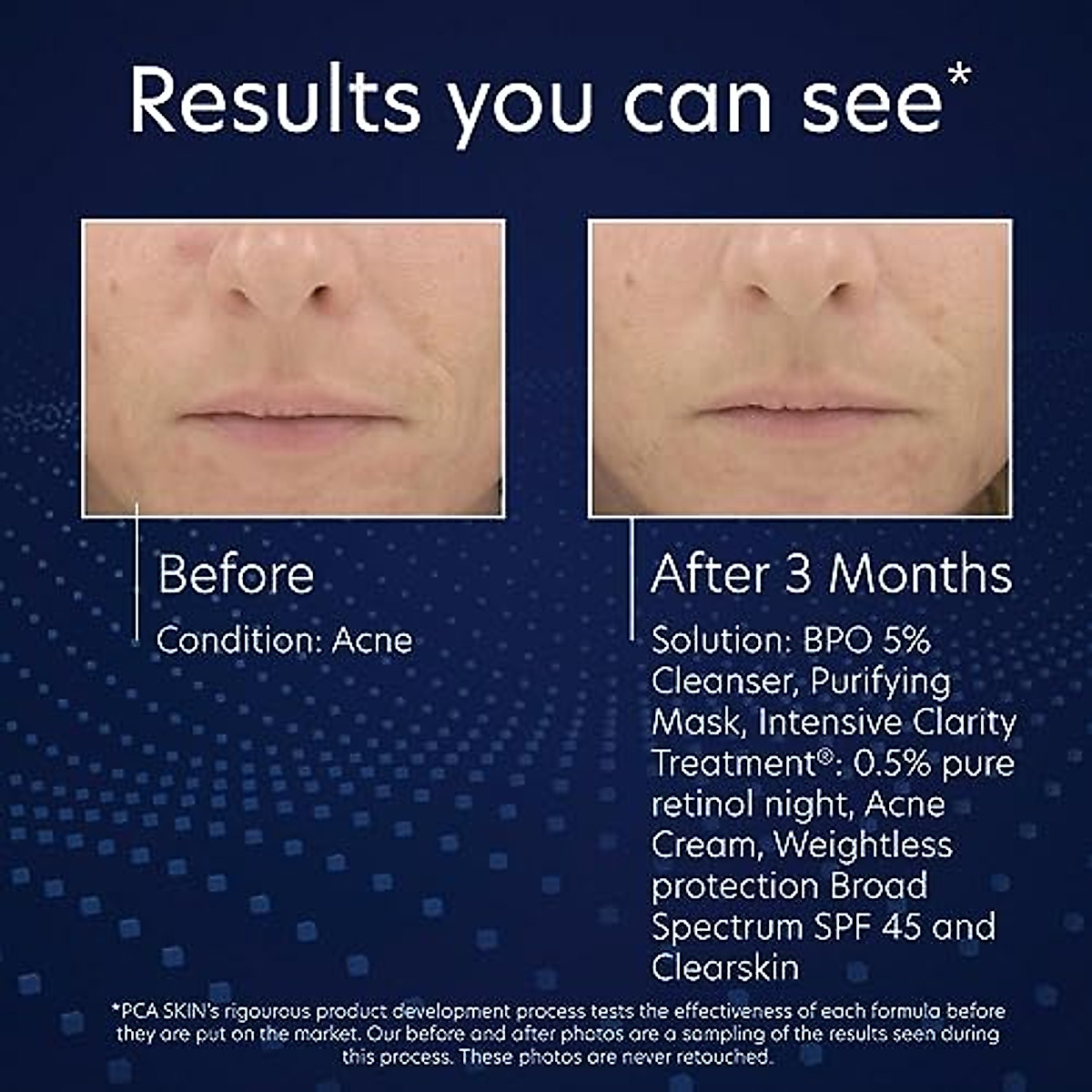 PCA SKIN 5% Benzoyl Peroxide Face Wash, Foaming Acne Facial Cleanser for Oily and Acne Prone Skin, Eliminates Existing Acne and Helps Prevent Future Breakouts, Cleanses and Calms, 7.0 oz Bottle