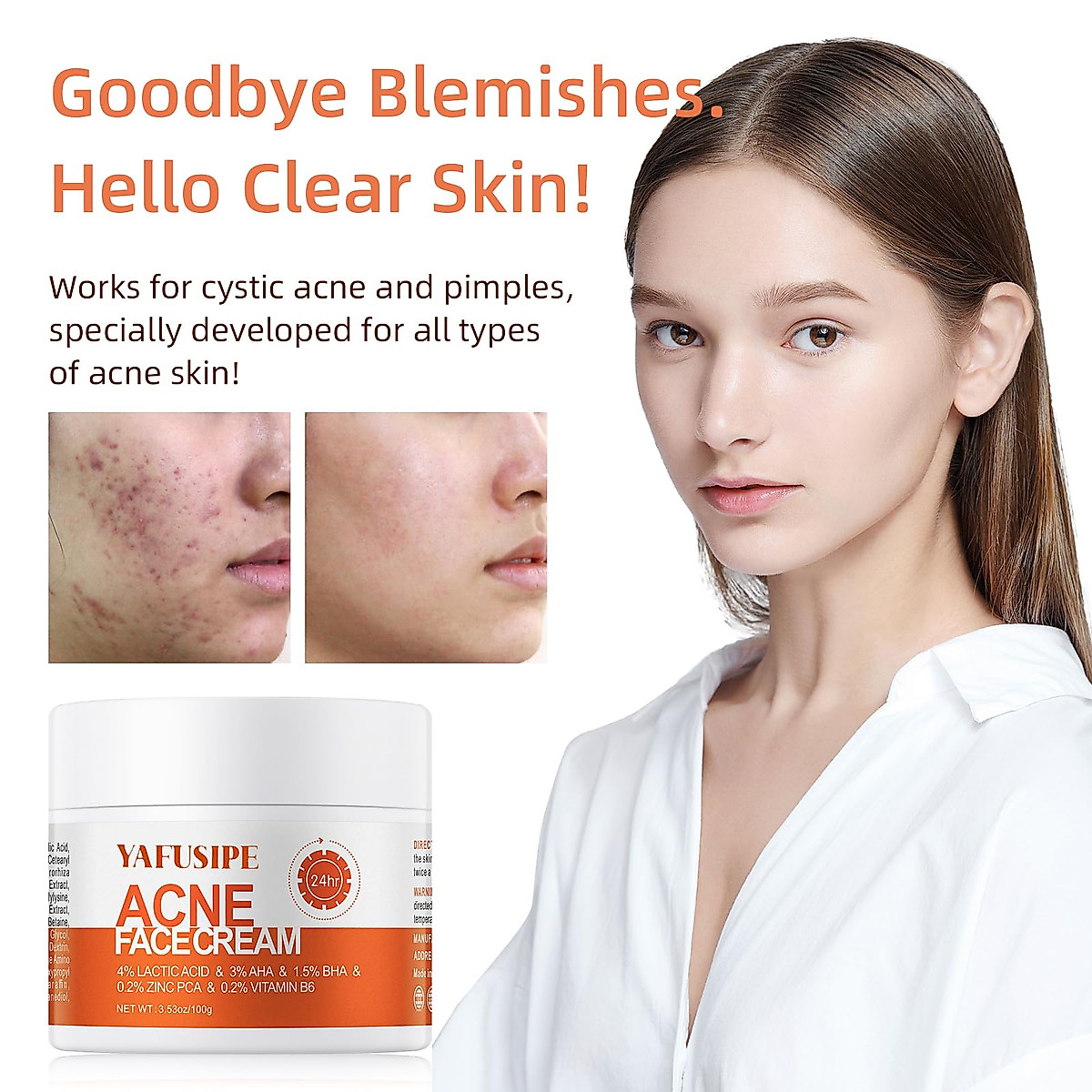 Acne Treatment for Face, Acne Cream Back Acne Treatment Cream for Teens & Adults Anti-acne Pimple Cream Butt Acne Clearing Cream, Acne Spot Treatment