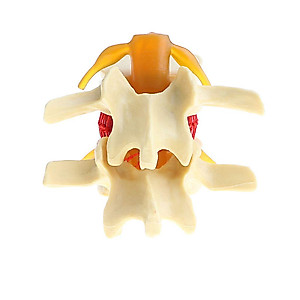 BONEW 4PCS Magnify 2X Human Spine Lumbar Vertebrae Degenerative Disc Medical Model
