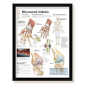 Set of 3 Framed Medical Posters Osteoarthritis Rheumatoid Arthritis Understanding Osteoporosis 22"x28" Wall Diagrams Educational Informational Doctors Office Rheumatology Charts