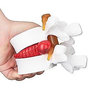 faruijie Disc Herniation Model - 1.5X Lumbar Herniated Disc Model Vertebral Spine Anatomical Medical Model