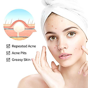 Acne Cream Pimple Cream for Face, Oil Control Pimple Remover Cream Get Rid of Pimples Fast,for Oily and Acne Prone Skin, Cruelty Free, Crema para espinillas en la cara