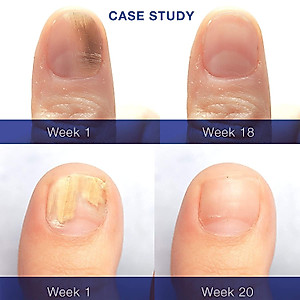 Toenail Fungus Treatment Extra Strength: Fungal Nail Renewal Liquid - Toe Nail Fingernail Repair for Damaged Discoloration Nails (1oz)