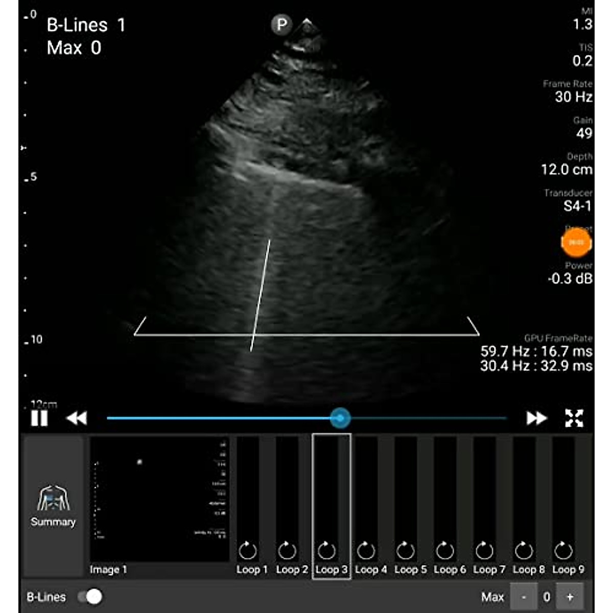 Philips Lumify S4-1 Phased Array Transducer, Portable Ultrasound Solution