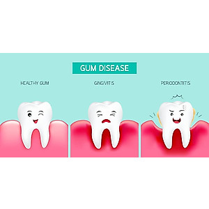 Perio Restore® Gel 3 Ounce Tube; 3 Pack. 1.7% Hydrogen Peroxide Oral Cleansing Treatment Gel. Includes Two (2) Trays for Ease of Application. Mint Flavor