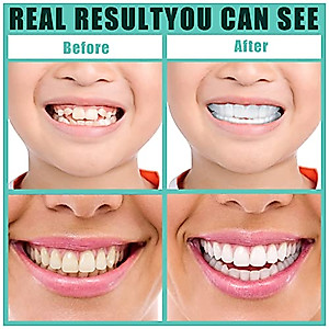 6 Set Fake Teeth Temporary Denture Teeth Veneer Snap in Teeth Confidence Smile Dentures Veneers Fake White Teeth with Mini Tweezers for Men and Women Bad Teeth Whitening Alternative