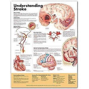 Understanding Stroke Anatomical Chart
