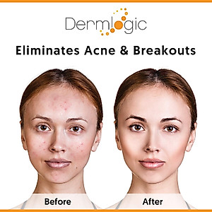 Dermlogic Acne Face & Body Cream- Maximum Strength Treatment for Cystic, Blackhead & Whitehead Pimples. Prevents Future Breakouts.
