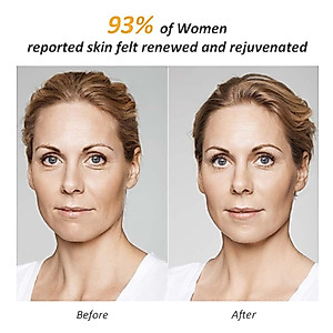 WarmDerm Skin Firming Facial Device, Professional Home Beauty Device for Face and Body, 3 Energy Levels - Salon Results