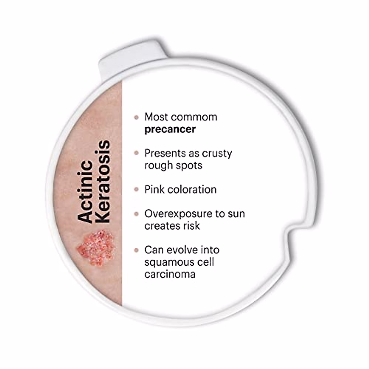 GPI Anatomicals - Skin Cancer Model, Replica with Precancerous and Cancerous Skin Lesions for Human Anatomy and Physiology Education, Anatomy Model for Doctor's Office, Medical Study Supplies