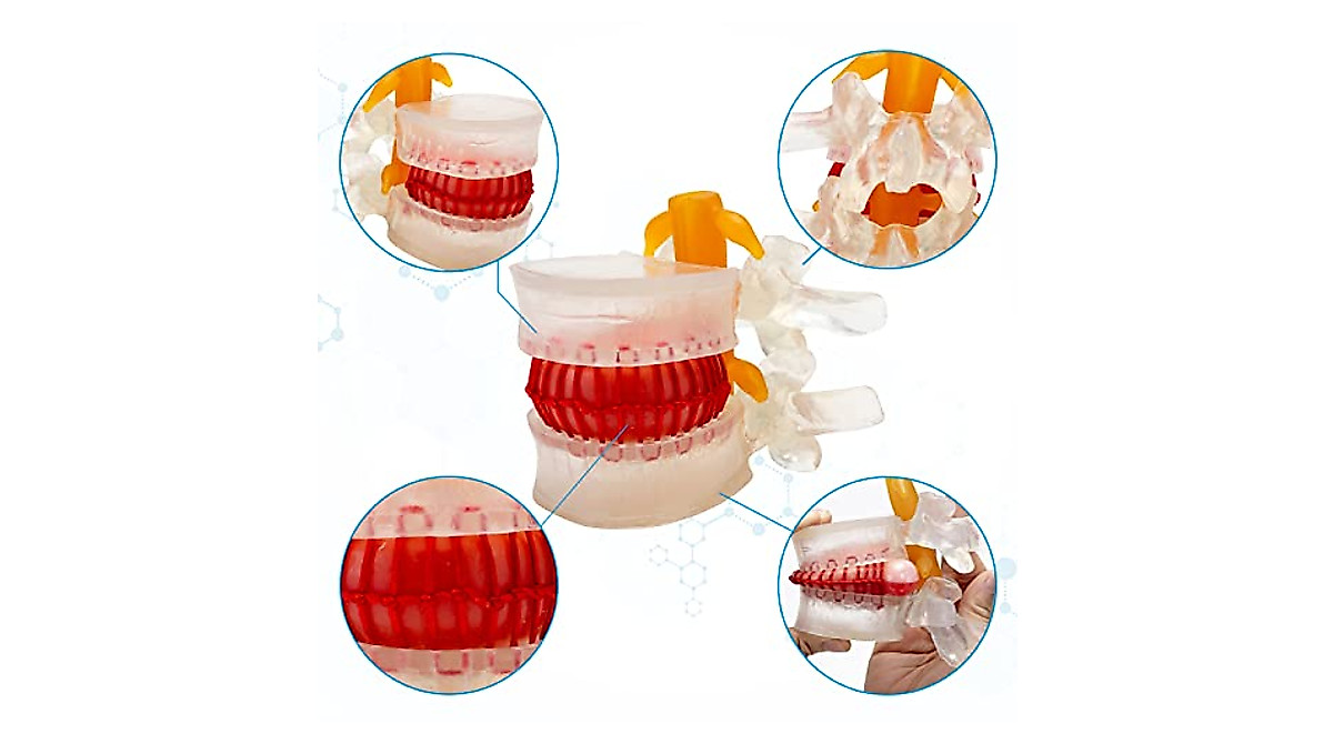 SKUMOD Lumbar Disc Herniation Model - Transparent Spinal Anatomy