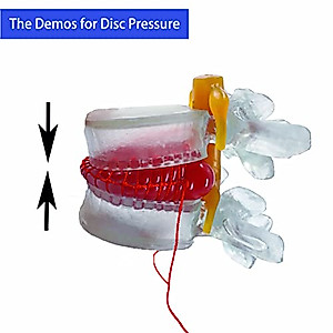Veipho Human Anatomical Lumbar Disc Herniation Model, Transparency Lumbar Disc Herniation Model, Lumbar Disc Model for Teaching and Demonstrating