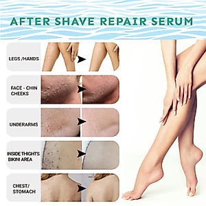 Ingrown Hair Treatment, After Shave Repair Serum For Ingrown Hairs & Razor Bump Treatment, Prevents Ingrown Hair Serum For Men and Women 100 Ml