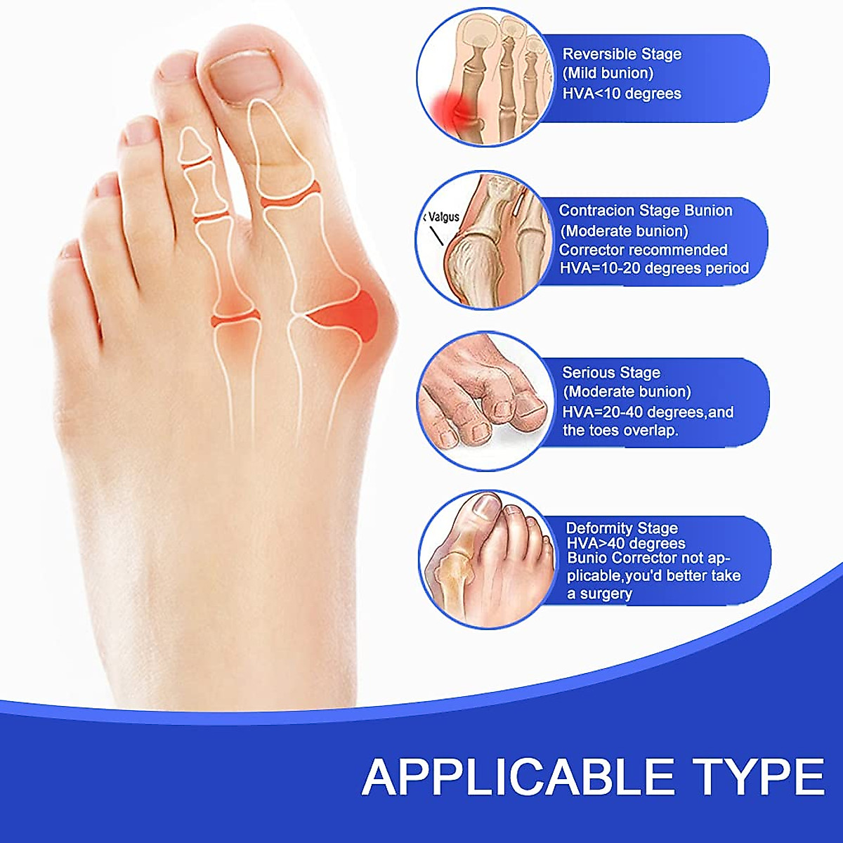 Toe Corrector Toe Separator Bunion Splint 【2024 Updated】 Hallux Valgus Bunion Big Toes Corrector Set Bunion Brace Bunion Exercise Strap Orthopedic Kit Bunion Pain Relief (free, Blue)