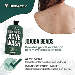 TreeActiv Acne Exfoliating Body Wash, 8oz, Foam Cleanser for All Skin Types, Sulfur, Aloe Vera, Jojoba Beads