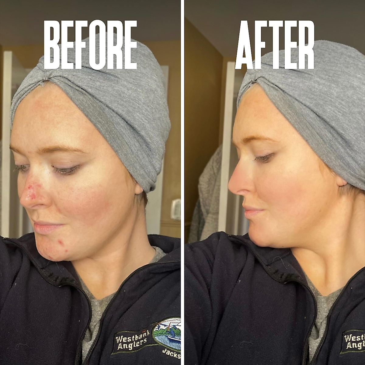 Glycolic Acid Peel 40% Professional Chemical Peel for Face for Acne Scars, Collagen Boost, Wrinkles, Fine Lines - Alpha Hydroxy Acid Liquid Exfoliant for Face Peel Mask for Men & Women