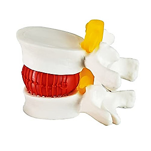 2023 New Human Anatomical Lumbar Herniation Model, Vertebrae Degenerative Lumbar Human Spine Model 1PCS,Lumbar Spine Model for Teaching & Learning - Excellent Way for Demonstrating Disc