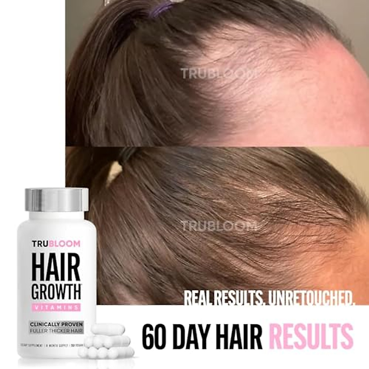 Tru Bloom Hair Growth Vitamins - 1 Month Supply. Clinically Proven for Fuller, Thicker Hair. Natural & Drug-Free. Ultimate Hair Vitamins for Proven Results