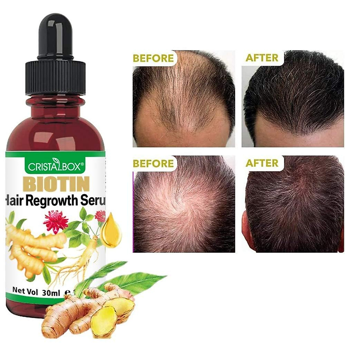 5 PACK Ginger Oil for Hair Growth,Hair Growth Serum,Biotin Hair Growth Oil,Hair Growth Ginger Serum for Men and Women,Hair Growth Treatment,Hair Loss Treatment,Promotes Thicker,Growth Hair
