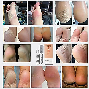 Feet Callus Remover - Instant Exfoliating Peel Foot Spray - Cracked Heels Softener – Metal Foot File Scrubber Dead Skin Remover Professional Spa Pedicure. Wonder Pedi
