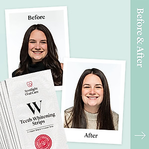 Spotlight Oral Care Teeth Whitening Strips | Gently Whitens Teeth Gradually & Safely (Whitening Strips)