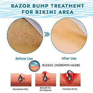 Ingrown Hair Treatment, After Shave Repair Serum For Ingrown Hairs & Razor Bump Treatment, Prevents Ingrown Hair Serum For Men and Women 100 Ml