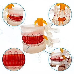 SKUMOD Human Lumbar Disc Herniation Model, Transparent Lumbar Spine Model, Lumbar Disc Anatomical Model with Elastic Software