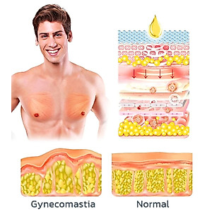 Chestdefy Gynekomastie Reduction Massage Oil,Gynecomastia Tightening Cream,Gynekomastie Reduction Massage Oil,Chest Reduction Massage Oil,Breast Tightening Cream,Breast Reduction Cream for Men (1pcs)