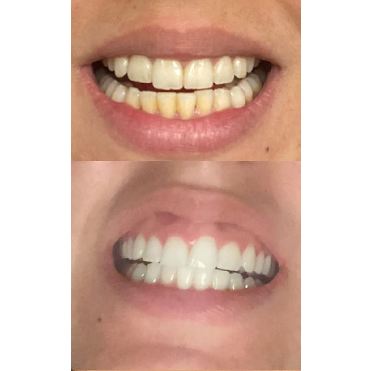 Dr Song Teeth Whitening Gel Refill 4X Syringes 35% Carbamide Peroxide