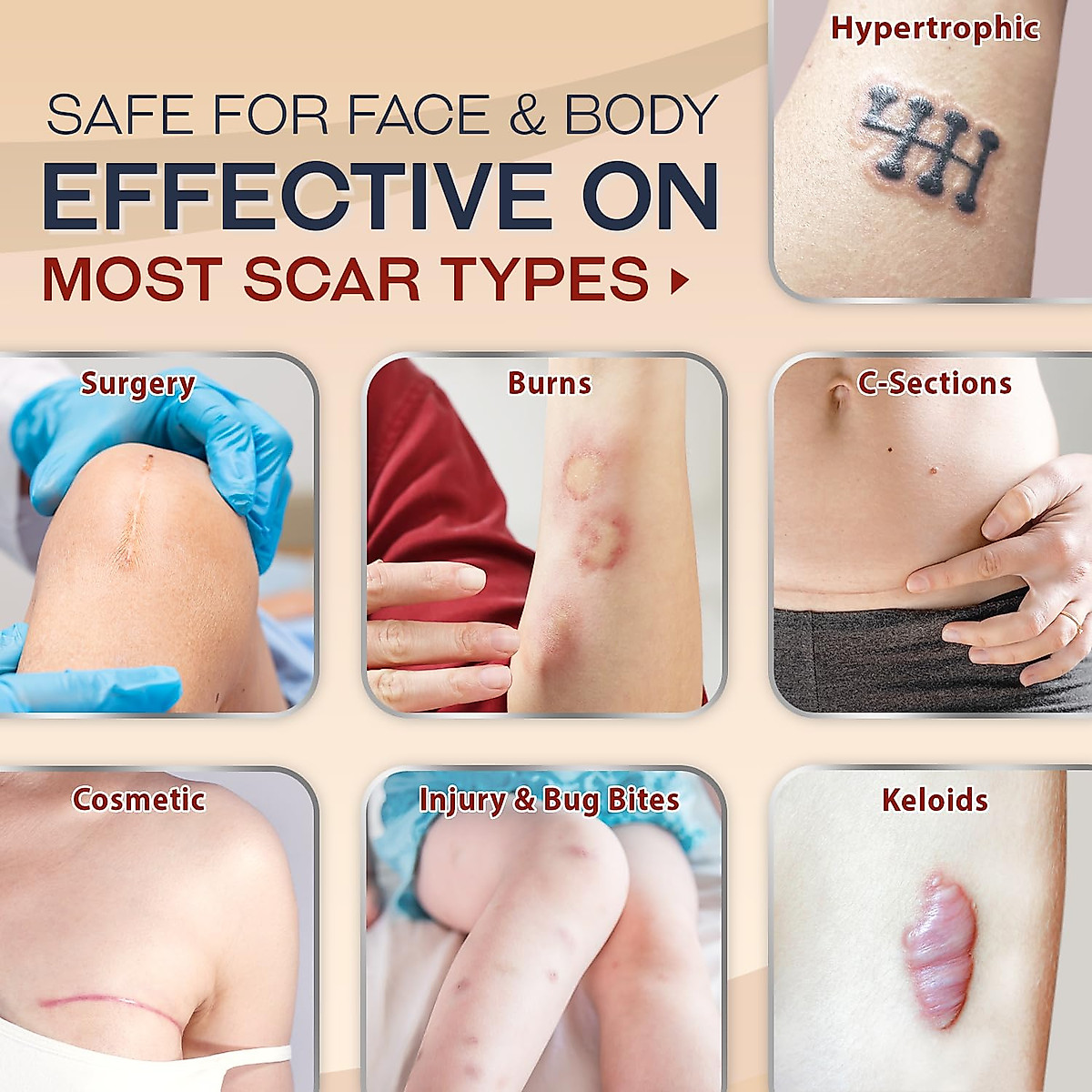 Ebanel Advanced Silicone Scar Gel with Allantoin, Emu Oil, Vitamin E and Onion Extract, Medical-Grade Cream for Old & New Scars from Surgeries, C-Section, Injuries, Burns, Keloids & More