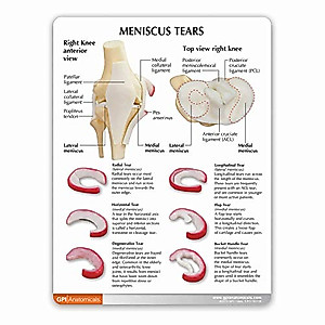 GPI Anatomicals - Human Anatomy Model of Knee Joint with Meniscus Tears, Replica for Anatomy and Physiology Education, Anatomy Model for Doctor's Office and Classrooms, Medical Study Supplies